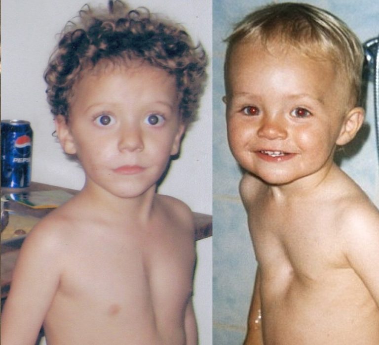 Profilaxia rahitismului. Ce este rahitismul - simptome, cauze si tratament