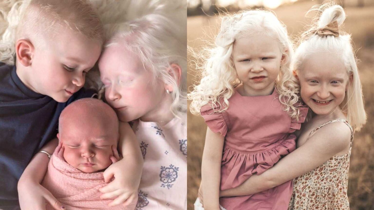 Totul despre albinism la copii: Cauze, simptome și tratament | Demamici.ro